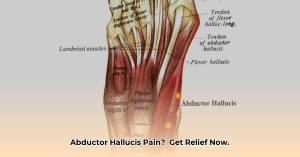 Abductor Hallucis Pain: Causes, Symptoms, Treatment, and Relief - The ...