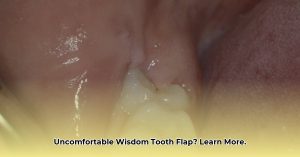 Dental Operculum: A Comprehensive Guide to Causes, Symptoms, and ...